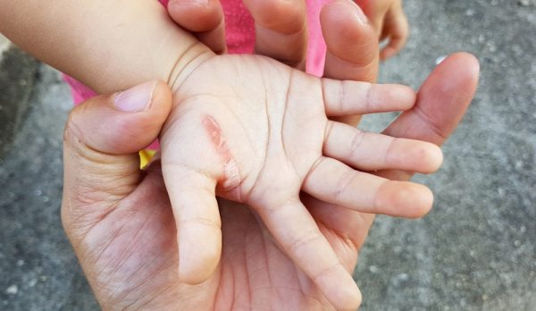 Verbrennungen behandeln: Verbrühungen & Verbrennungen bei Kindern